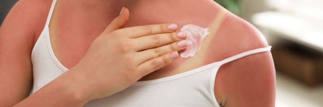 Summer skin problems? Tips for heat rash & sun allergy | Beauty Plaza