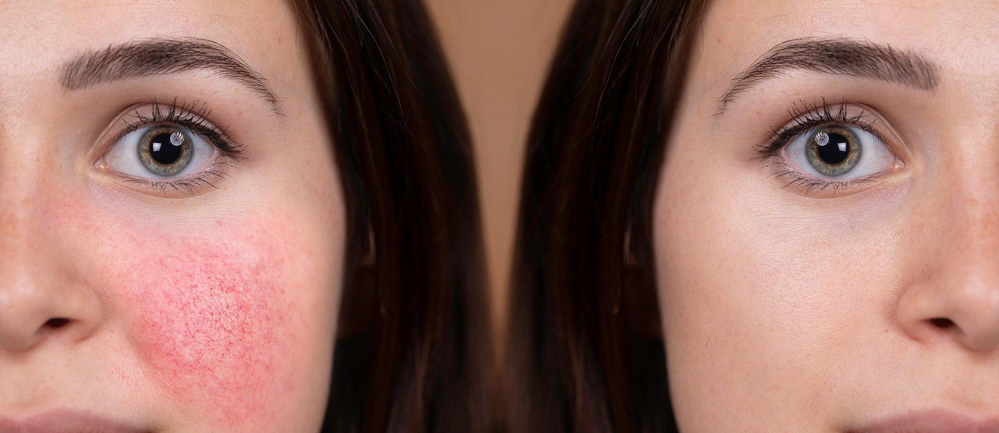 What to do with rosacea? Tips and info | Beauty Plaza